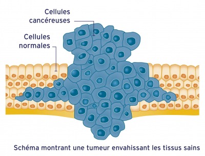 Comment se forme une tumeur ? - Fondation contre le cancer
