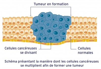 Comment se forme une tumeur ? - Fondation contre le cancer